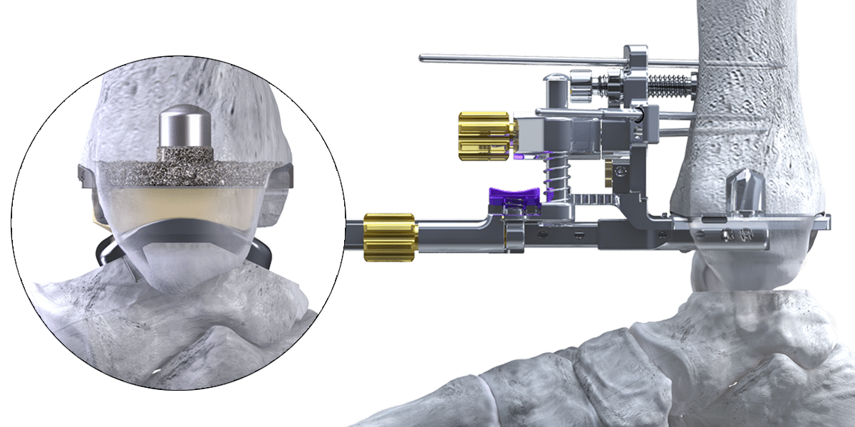 APEX 3D™ Total Ankle Arthroplasty Course – May 2025 - Paragon28